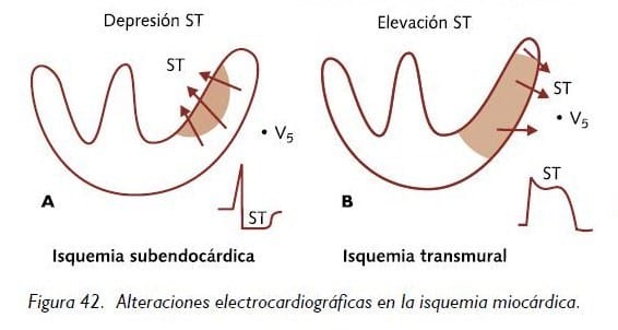 ¿Qué es un INFARTO AGUDO DE MIOCARDIO, SCASEST, SCACEST?